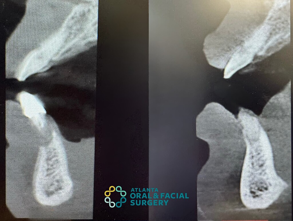 Preserving the Ridge with DALI One Graft Plug: A Case Study - This Week ...