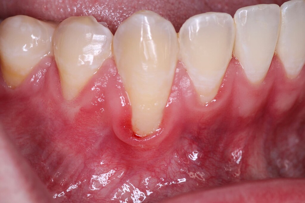 Good Ol' Gingival Graft: The Gold Standard - This Week in Implants ...
