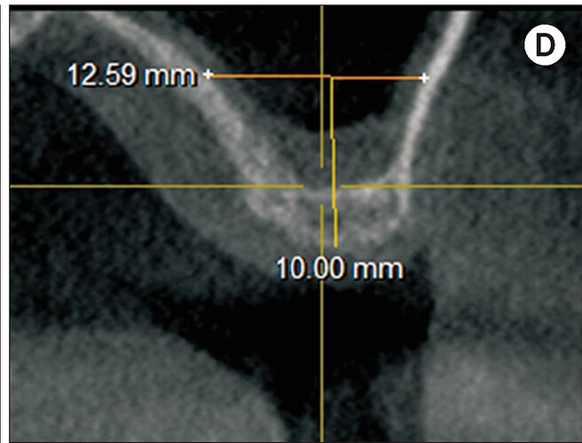 A New Simpler Technique for Sinus Lift - This Week in Implants ...