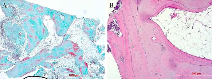 Gain Bone with the Cortical Shell Technique - This Week in Implants ...