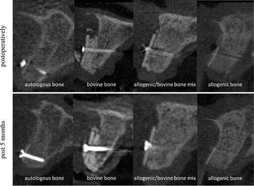 Gain Bone with the Cortical Shell Technique - This Week in Implants ...