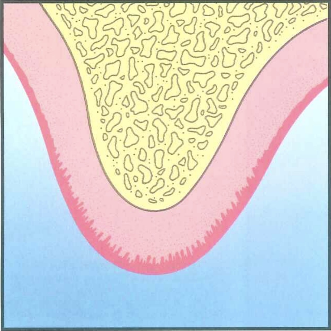 Restoration of the Buccal Contour with a Modified Palatal Roll - This ...