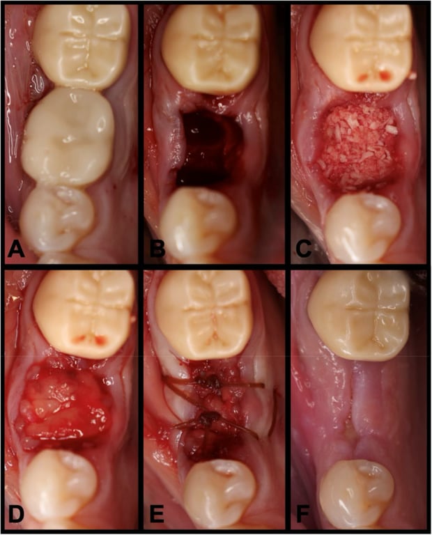 Improving PRF and Enhancing Long-Term Stability of Overdentures - This ...