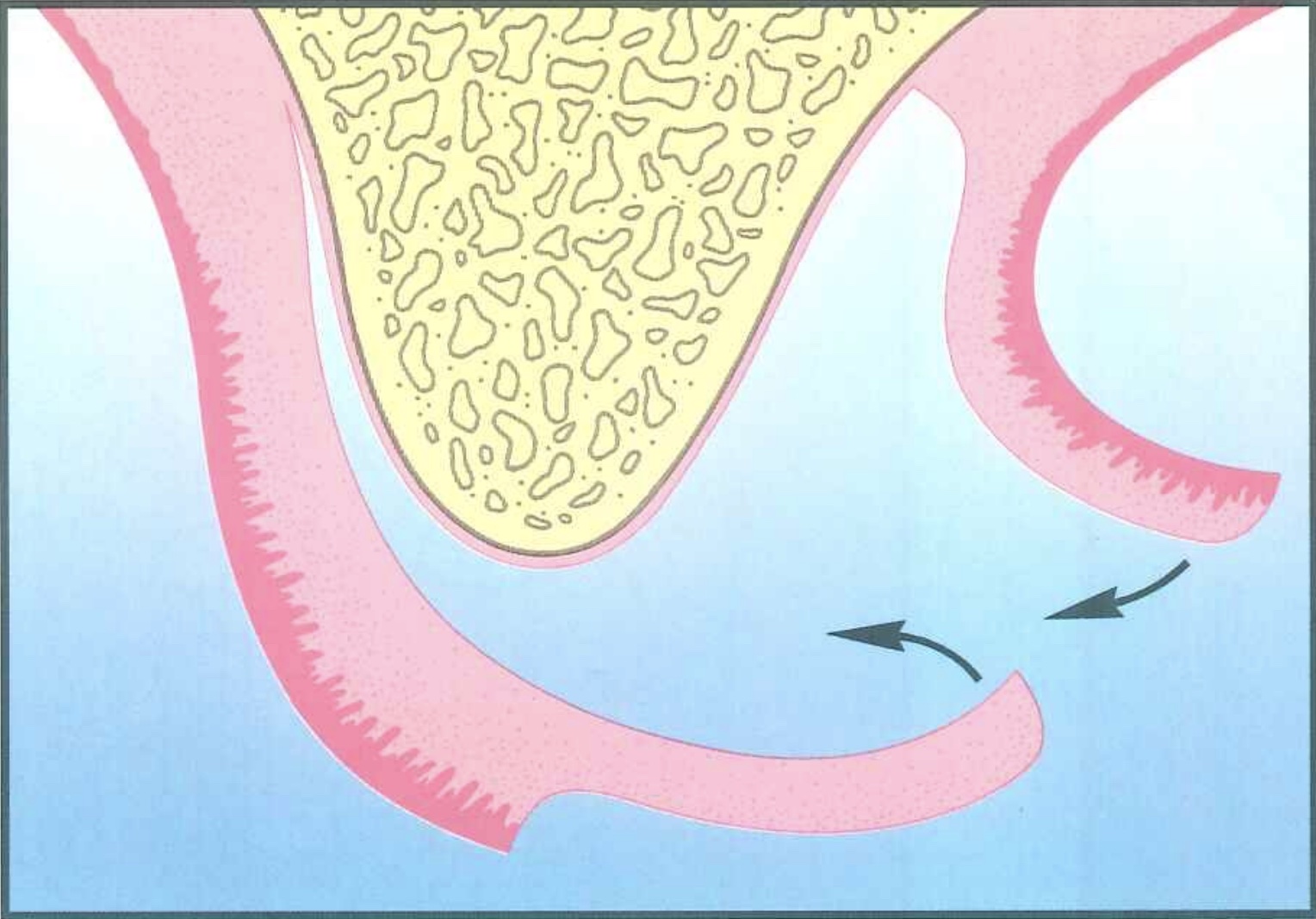 Restoration of the Buccal Contour with a Modified Palatal Roll - This ...
