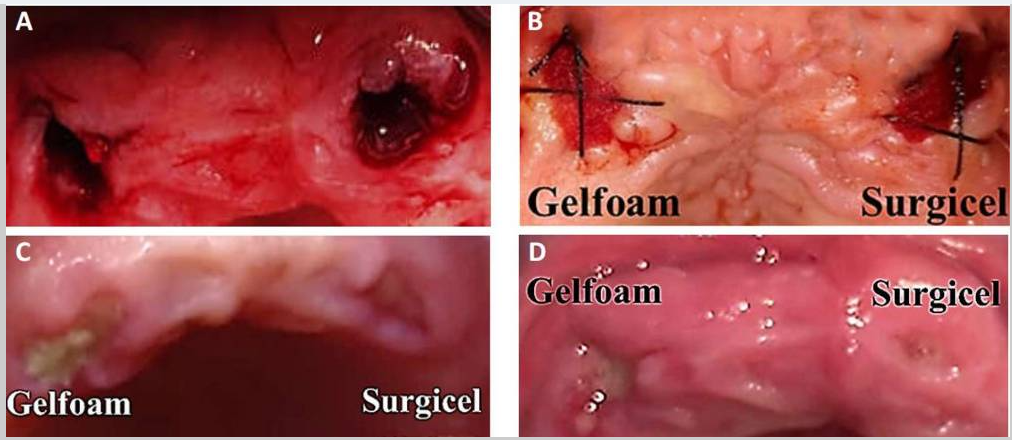 Post-Extraction Healing: Surgicel vs Gelfoam? - This Week in Implants - DDSGadget Community