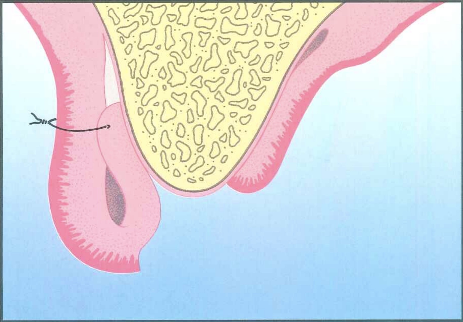 Restoration of the Buccal Contour with a Modified Palatal Roll - This ...